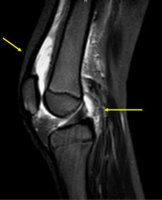 Rapid MRI for Acute Musculoskeletal Infection Protocol - Radiating Hope